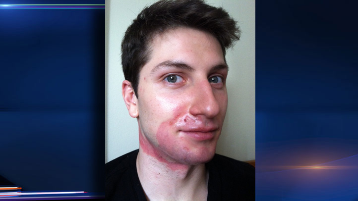 Burned Lyric Actor Cleared to Return to Work – NBC Chicago