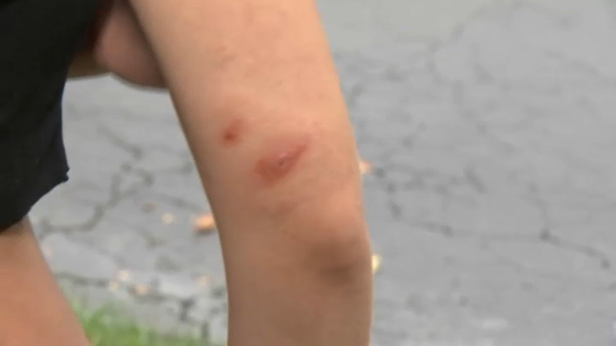Mysterious, Nasty Bug Bites Stump Arlington Health Officials – NBC Chicago