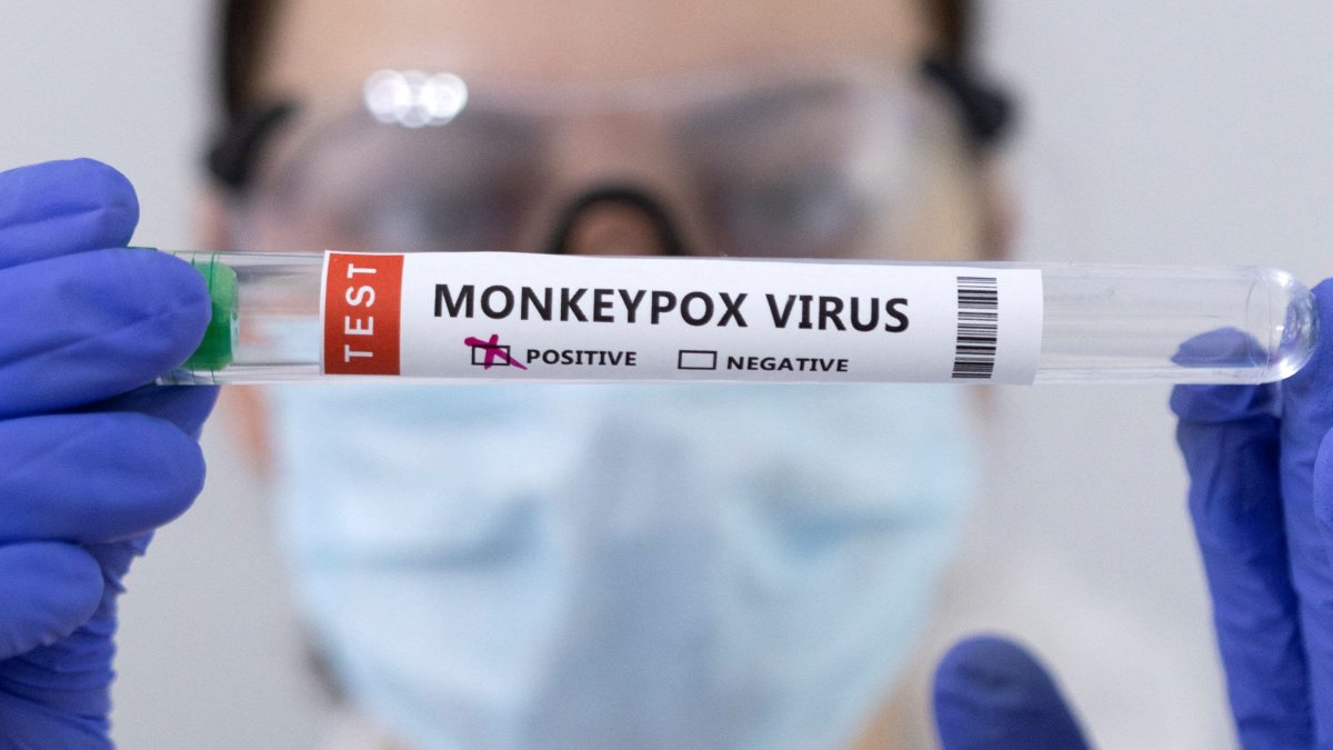 Illinois Has Seen Monkeypox Before, But Doctors Say These US Cases Are ...