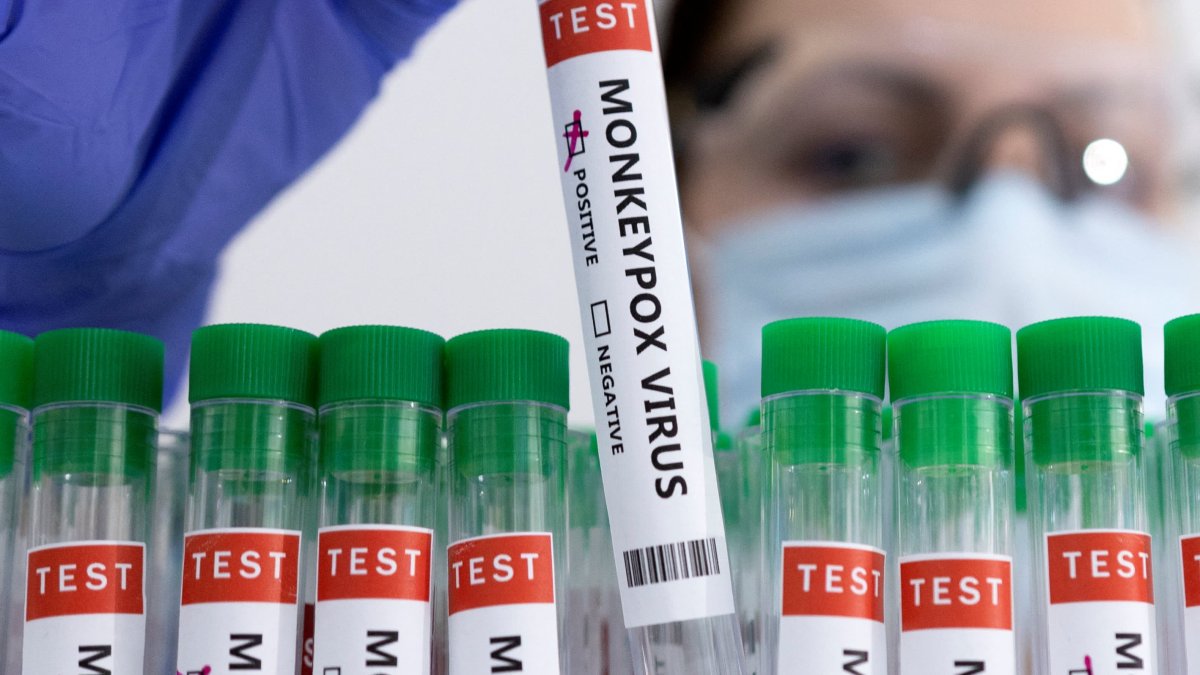 2nd Probable Case of Monkeypox Reported in Illinois, Health Officials ...