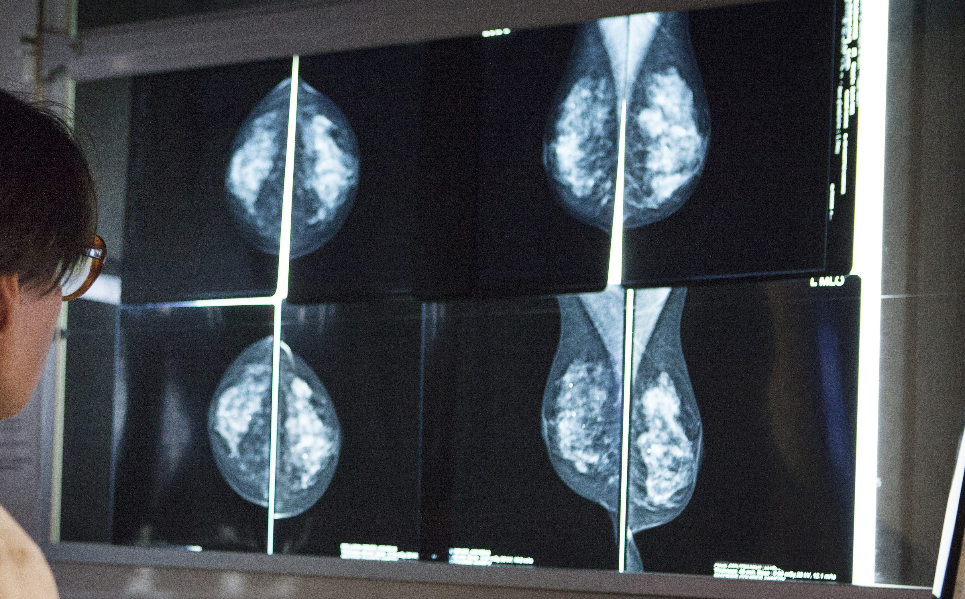 What Does it Mean to Have Stage 1A Breast Cancer? – NBC Chicago