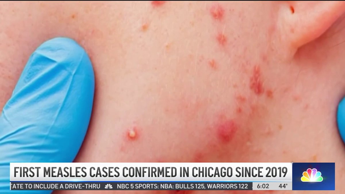 2 measles cases confirmed in Chicago in first city cases since 2019 ...