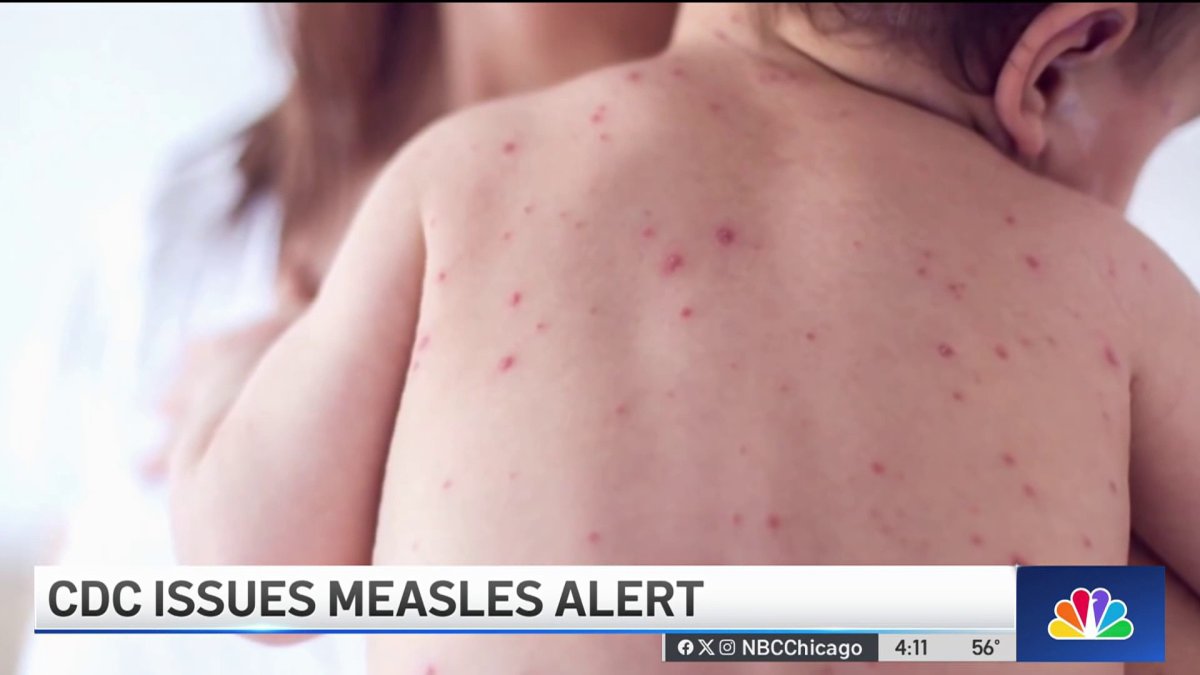 CDC issues measles alert with cases detected in 17 states – NBC Chicago CDC issues measles alert with cases detected in 17 states – NBC Chicago