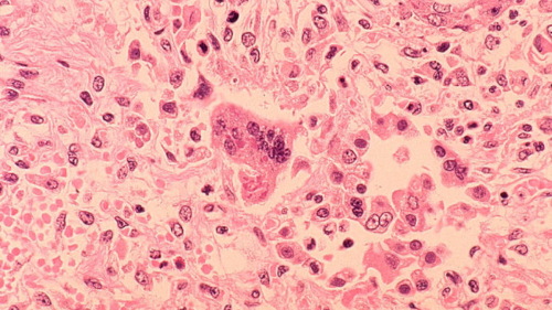 2 measles cases confirmed in Cook County: health officials – NBC Chicago