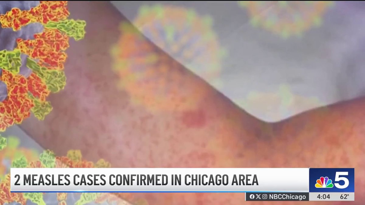 2 measles cases reported in Chicago area – NBC Chicago