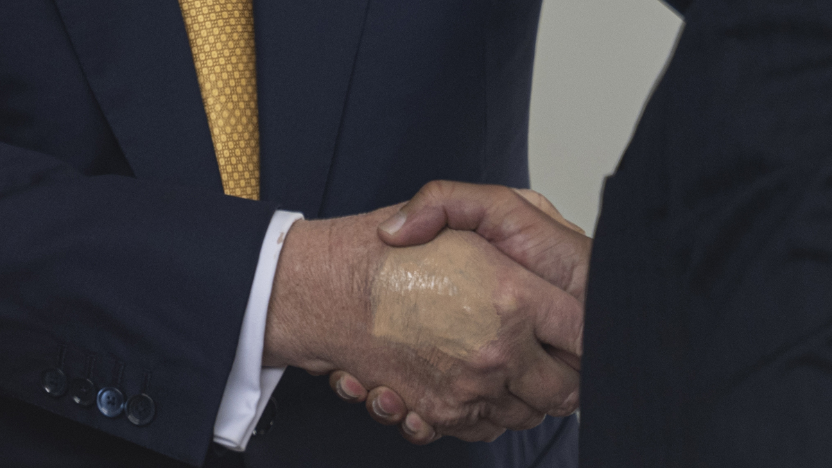 Trump is diagnosed with chronic venous insufficiency – NBC Chicago