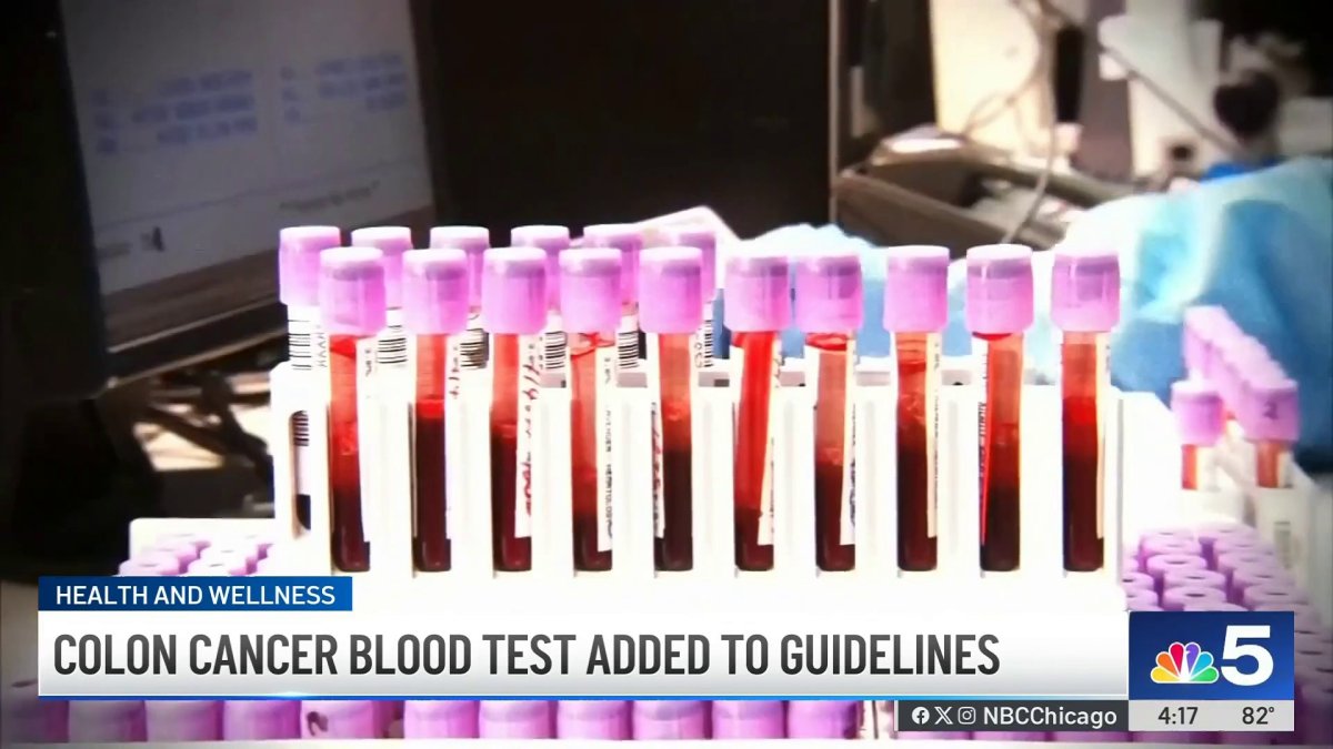 Blood test added to colon cancer screening guidelines – NBC Chicago